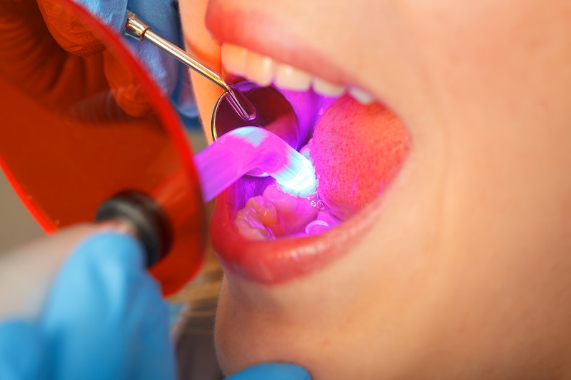 Teeth Bonding: What You Need to Know - Caress Dental